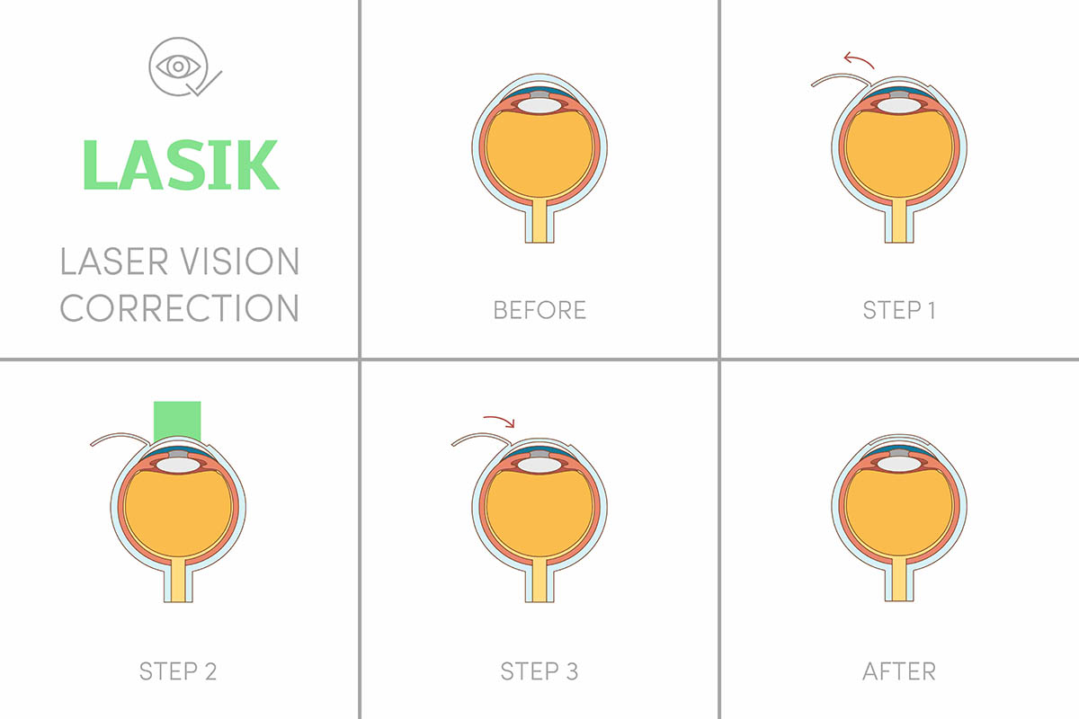 POHS Treatment in Chicago, IL | Kraff Eye Institute